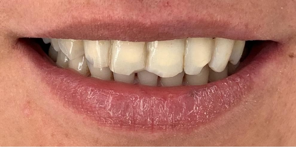 Fallbeispiel - Frontzahnkronen - Zahnarzt Gelsenkirchen - Dental ...